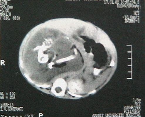 11 Bizarre Facts About Fetus In Fetu Syndrome