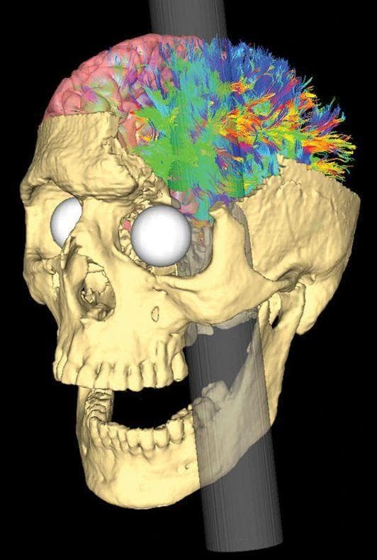 Horrifying Facts About Phineas Gage - The Man Who Impaled His Brain