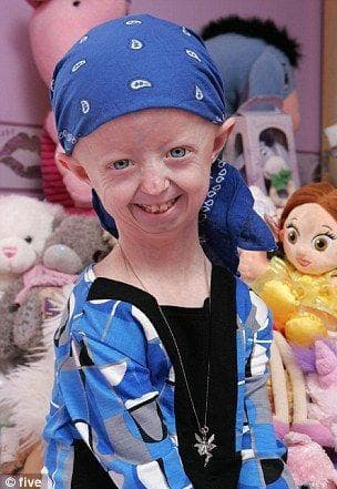15 Fascinating Facts About Progeria, The Rapid Aging Disease