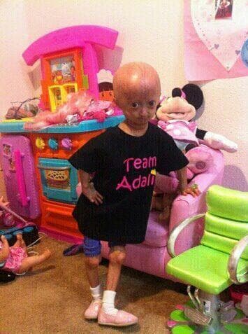 15 Fascinating Facts About Progeria, The Rapid Aging Disease