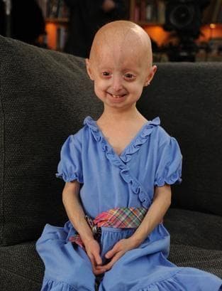 15 Fascinating Facts About Progeria, The Rapid Aging Disease