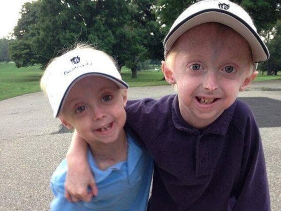 15 Fascinating Facts About Progeria, The Rapid Aging Disease