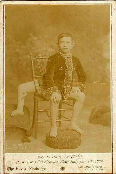 The Strange Life Of Frank Lentini, "The Three-Legged Wonder"