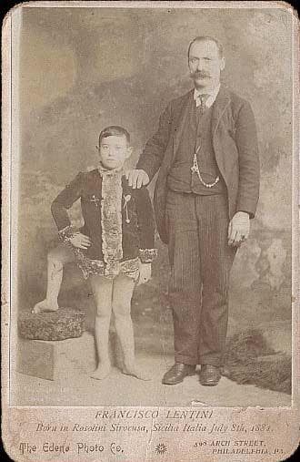 The Strange Life Of Frank Lentini, "The Three-Legged Wonder"