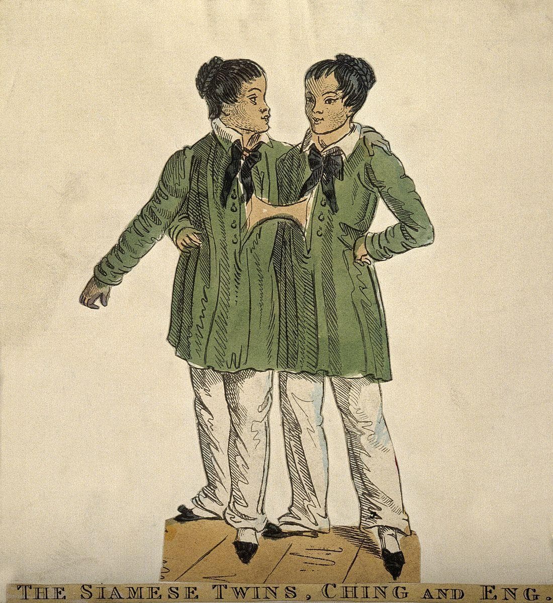 The Strange Lives Of Chang And Eng Bunker, The Original Siamese Twins