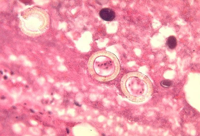 Here's What Happens To Your Body When You Eat A Tapeworm