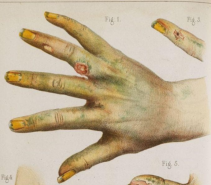 The Deadly History Of Arsenic Through The Ages