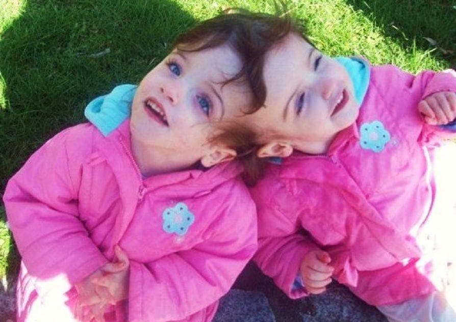 Real Answers To Questions You've Always Had About Conjoined Twins