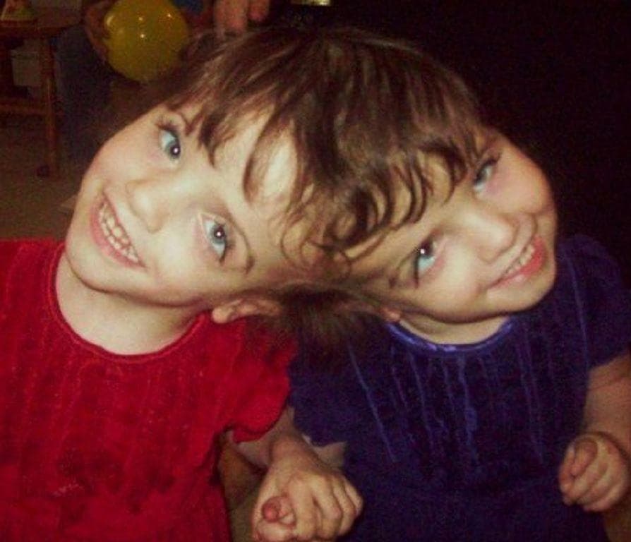 Real Answers To Questions You've Always Had About Conjoined Twins