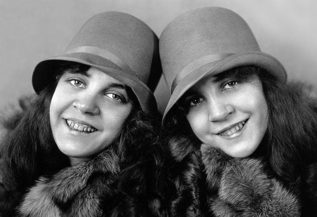 Real Answers To Questions You've Always Had About Conjoined Twins