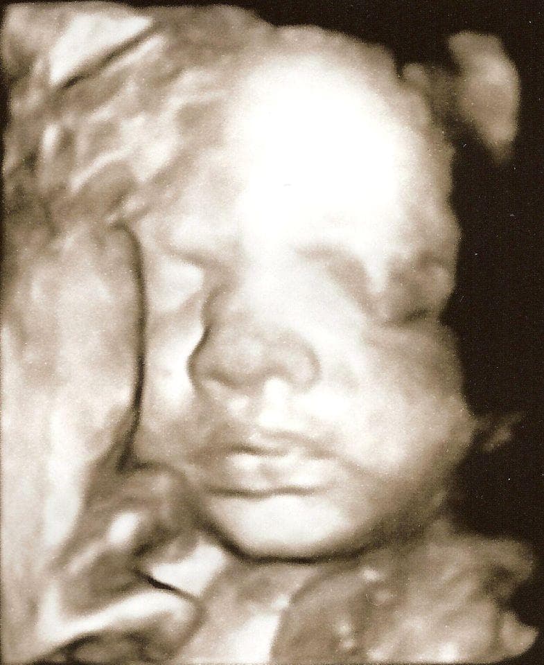 "Stone Fetuses" Can Grow In A Woman's Body For Decades