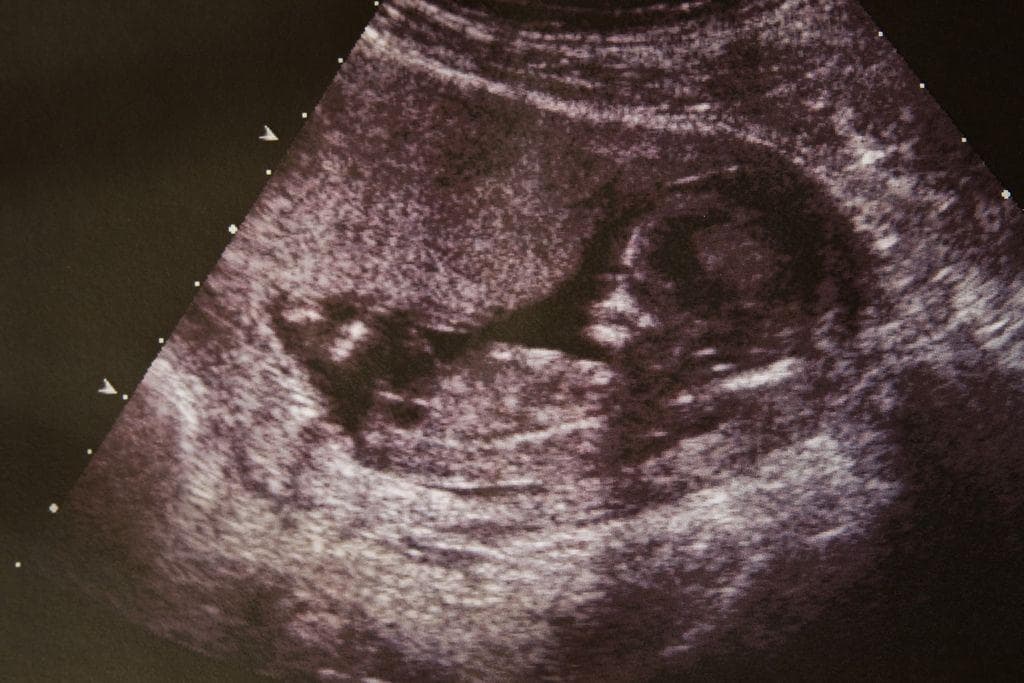 "Stone Fetuses" Can Grow In A Woman's Body For Decades