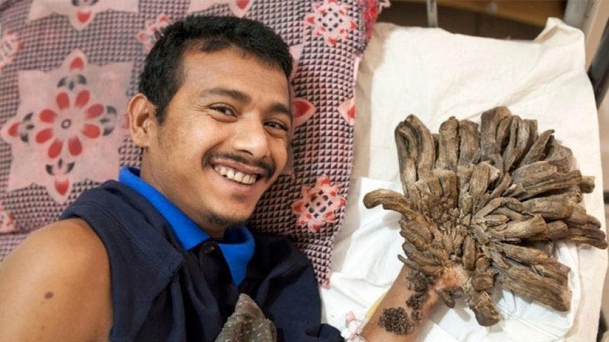 Tree Man Disease Is A Rare And Incurable Condition