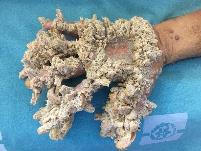 Tree Man Disease Is A Rare And Incurable Condition