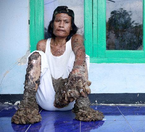 Tree Man Disease Is A Rare And Incurable Condition