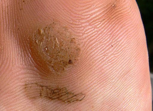 Tree Man Disease Is A Rare And Incurable Condition