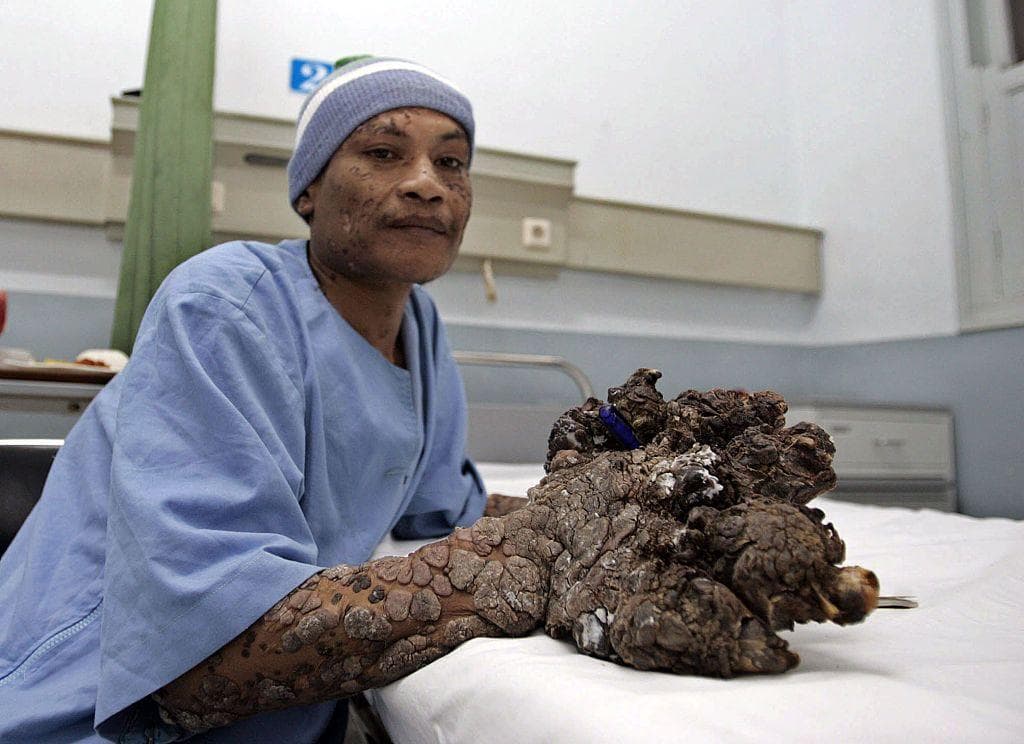 Tree Man Disease Is A Rare And Incurable Condition