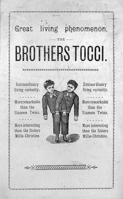 The Tocci Twins Exploited Their Own Rare Condition To Get Rich And ...