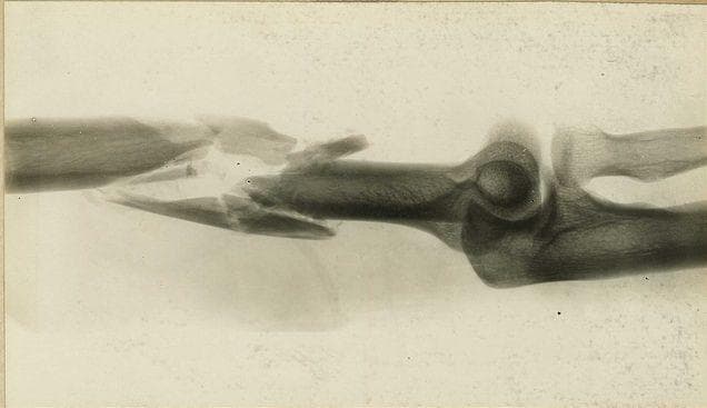 Here Is What Actually Happens To Your Body If You Get Tetanus