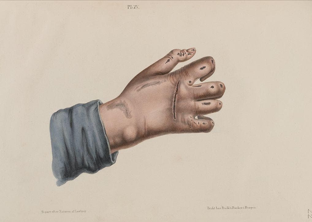 Here Is Everything You (Never) Wanted To Know About Leprosy