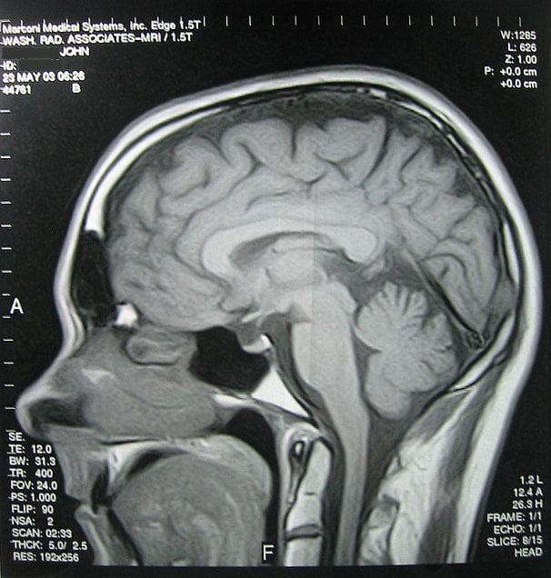 “Brain In A Bucket” Is A Creepy New Study That Could Lead To A “Living ...