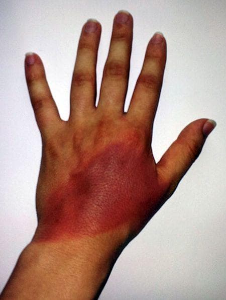 Here Are The 16 Most Painful Injuries Someone Can Experience