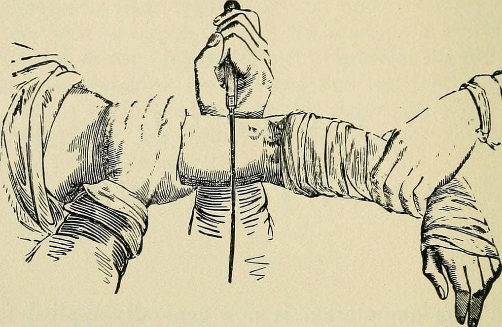 There Are Centuries Old Grave Sites Just For Amputated Limbs That You ...