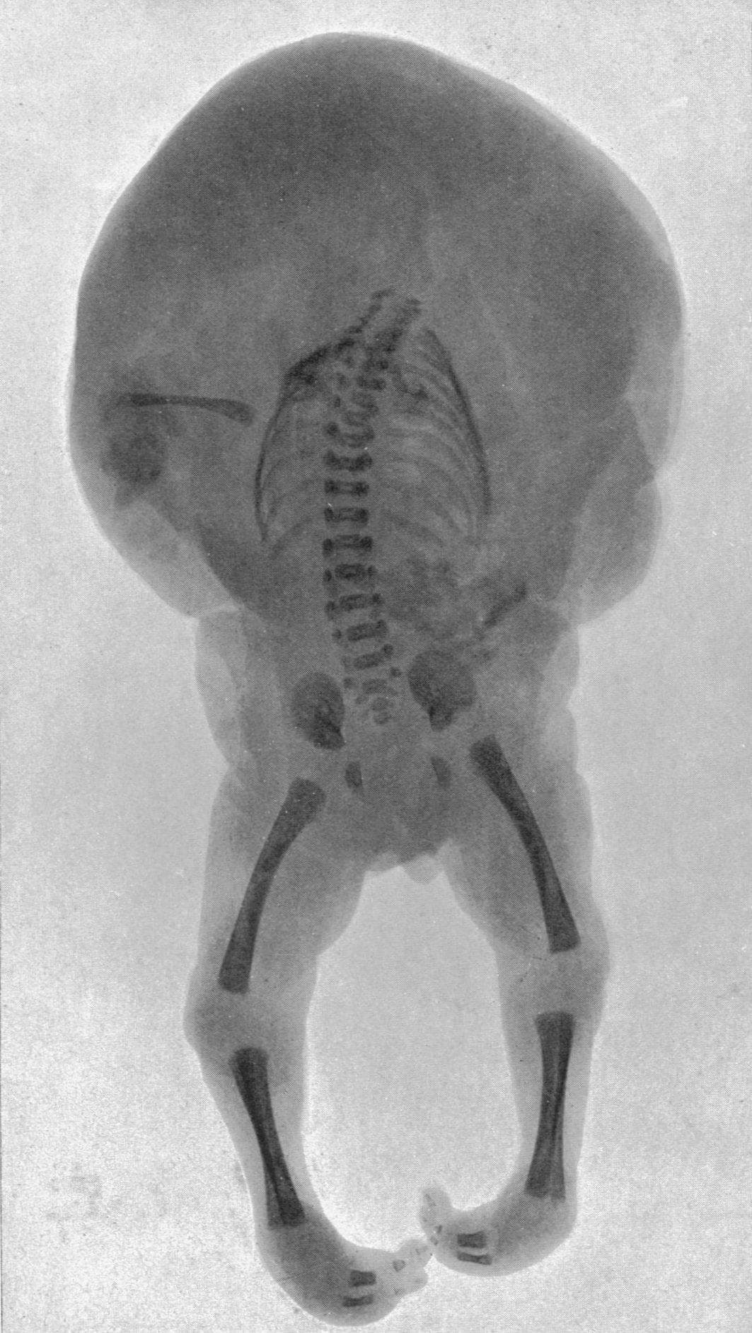 12 Fascinating Facts About Parasitic Twins