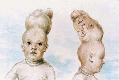 12 Fascinating Facts About Parasitic Twins