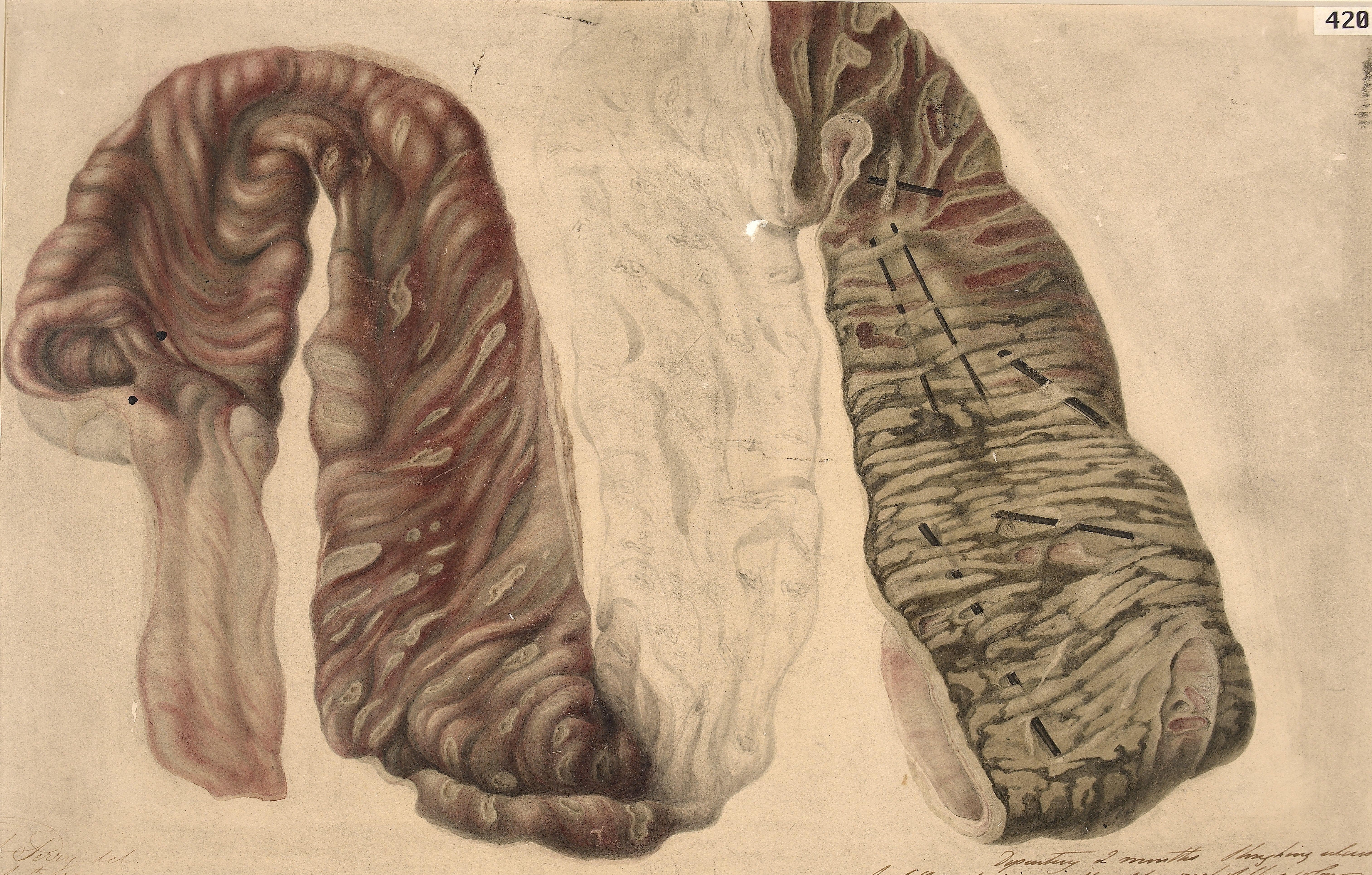 What Is Dysentery And What Does It Do To Your Body?
