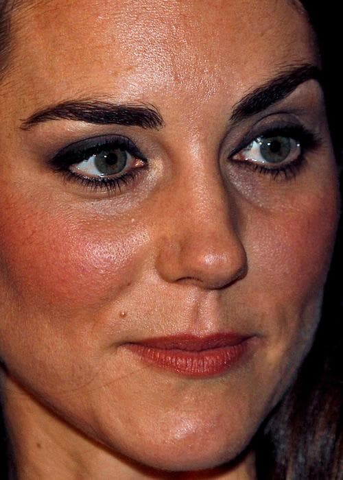 Celebrities With Acne | Famous People Who Had Acne When They Were Young