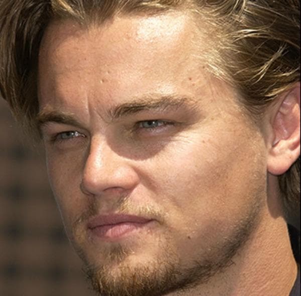 Celebrities With Acne