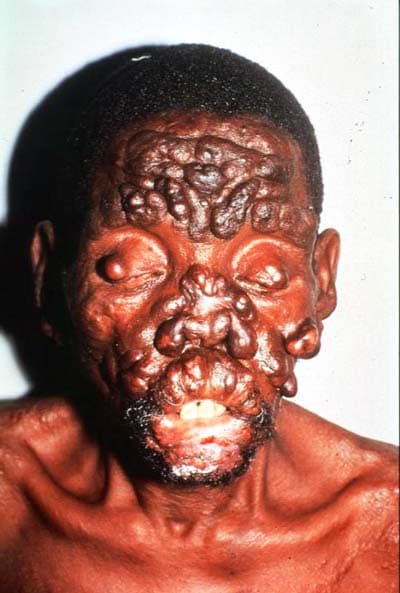 Gross Body Pictures – Pictures of Bumps on Skin: Cysts, Skin Tags ...